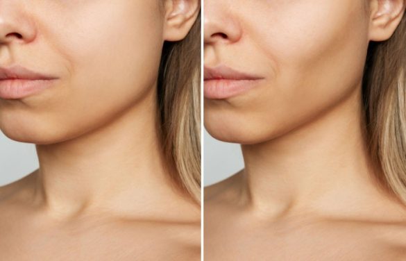 Dimple Surgery - Benefits and More - Vigor Blog - 2023