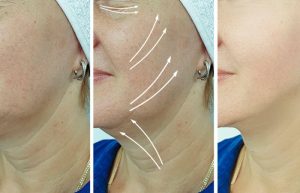 Dimple Surgery - Benefits and More - Vigor Blog - 2023
